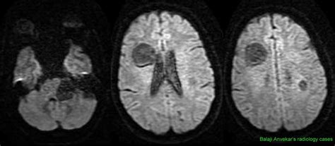 Dr Balaji Anvekar Frcr Hydatid Cysts Brain