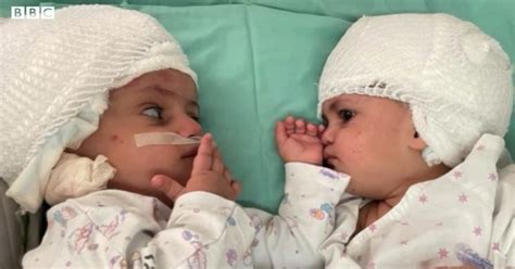 머리 붙어 태어난 샴쌍둥이 자매 처음 마주 봤다