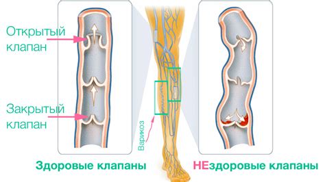 Как применять березовый деготь при трофической язве
