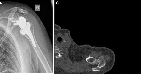 Uw Shoulder And Elbow Academy Acromion And Spine Fractures After