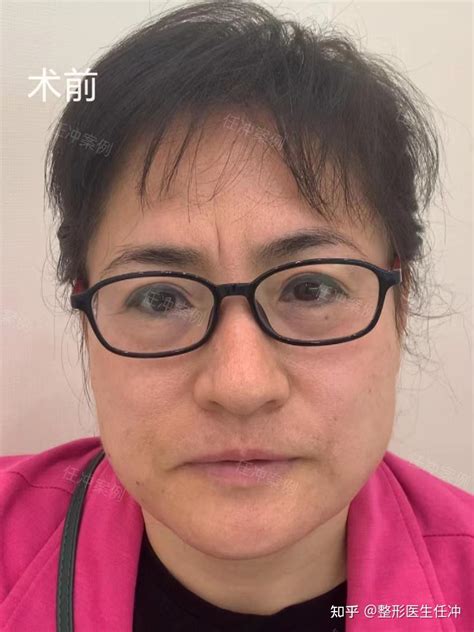 50多岁从山西跑到北京做了眉间川字纹，1年过去了，感觉悔不该当初 知乎