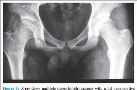 Figure 1 From Surgery Of A Rare Case Of Multiple Synovial