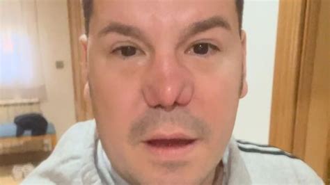 Lucas De Andy Y Lucas Se Operará La Nariz El Duro Preoperatorio Al Que Está Sometido