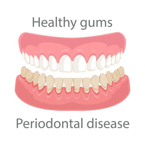 Gum Disease Gingivitis Clip Art Illustrations Royalty Free Vector