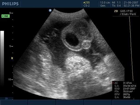 Congenital Hydrocele Eurorad