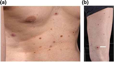 A Well‐circumscribed Erythematous Macules Which Have A Slightly