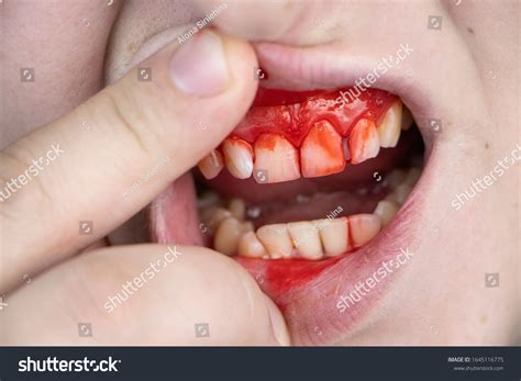 Bleeding Tooth Images Stock Photos Vectors Shutterstock