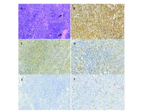 Pathological Features Of Inguinal Lymph Node Biopsy Specimen Before Btk Download Scientific
