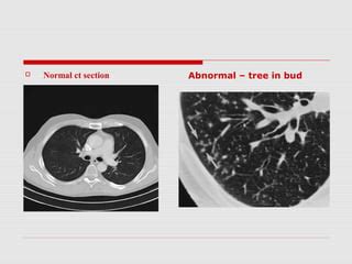 Imaging Endobronchial TB PPT Lung And Respiratory Health Diseases And Conditions