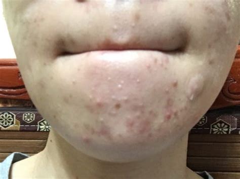 약국 여드름패치 턱 뾰루지 진정 과정 네이버 블로그