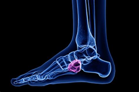 Managing Cuboid Bone Injuries Blog