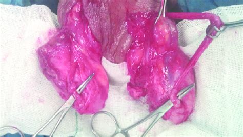 Bilateral Epididmal Agenesis Download Scientific Diagram