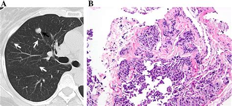 Imaging Appearances Of Diffuse Idiopathic Pulmonary Neuroendocrine Cell