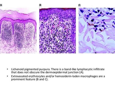 Interface Dermatitis Tutorial