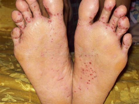 Foot Disease Rheumatism And Gout Red Leg Swelling Stock Image