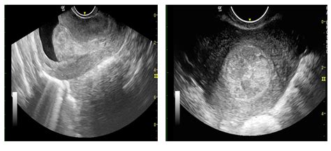 Transvaginal Sonographic Diagnosis Of An Endometrial Polyp Causing