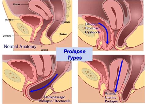 Pelvic Organ Prolapse You Are Not Alone Food Renegade
