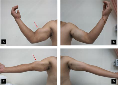 Popeyes Sign Biceps Tendon Rupture Bmj Case Reports