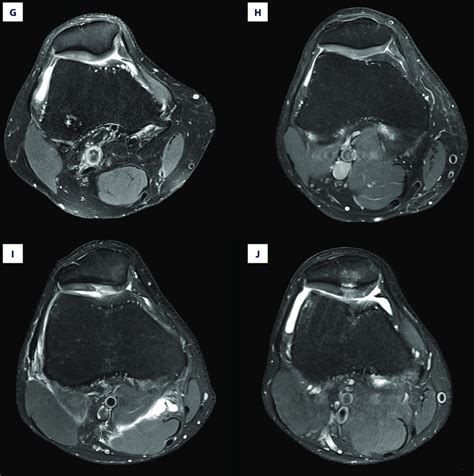 a j axial pd weighted images with patellar chondromalacia white