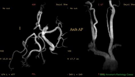 Dr Balaji Anvekar Frcr Insular Ribbon Sign In Acute Ischemia