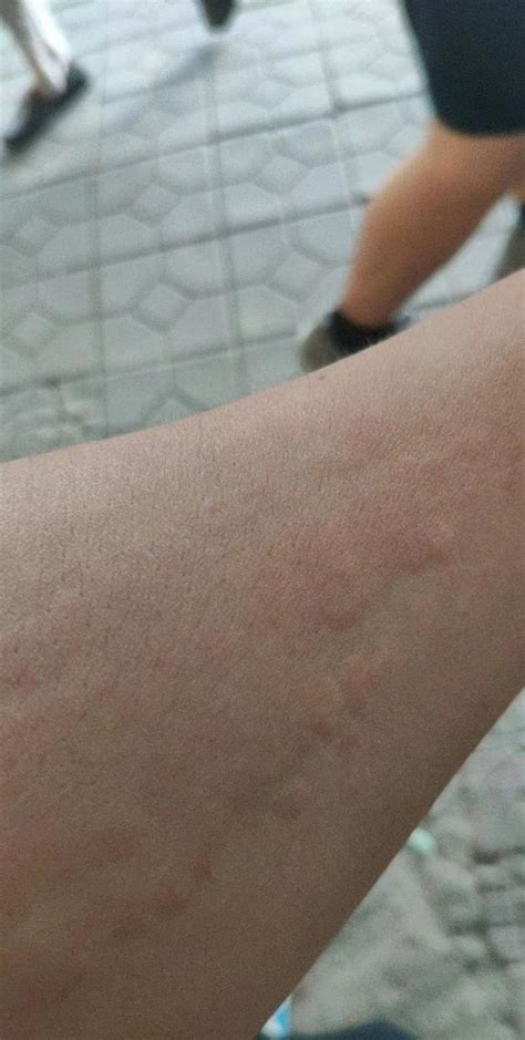 什么荨麻疹患者皮肤被划后有隆起的划痕 知乎