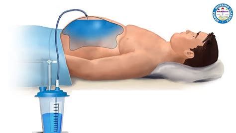 Paracentesis Procedure Definition Purpose Procedure Nanda
