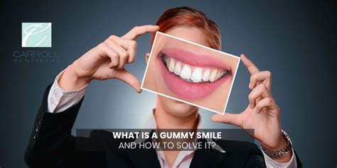 What Is A Gummy Smile And How To Solve It Carroll Dentistry