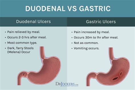 Endoscopy Stomach Ulcer Symptoms At Gregorio Fields Blog