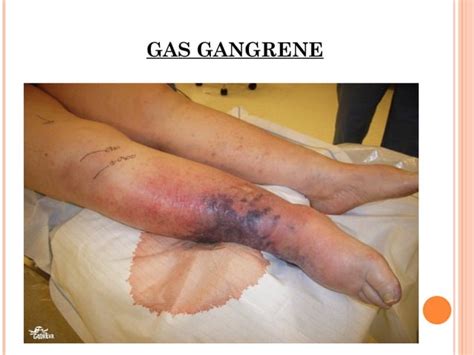Gas Gangrene And Scope Of Homoeopathic Management Ppt