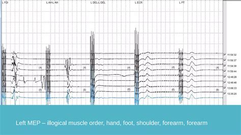 Multi Modality Intraoperative Neurophysiologic Monitoring PPT
