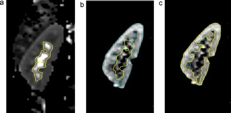 Testretest Reliability And Repeatability Of Renal Diffusion Tensor Mri In Healthy Subjects