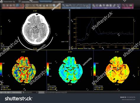 Perfusion Ct Scan Image Brain 3d 스톡 일러스트 1513433276 Shutterstock