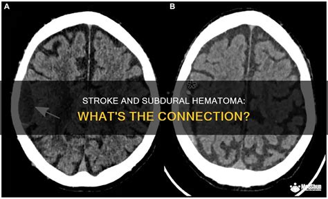 Stroke And Subdural Hematoma Whats The Connection Medshun