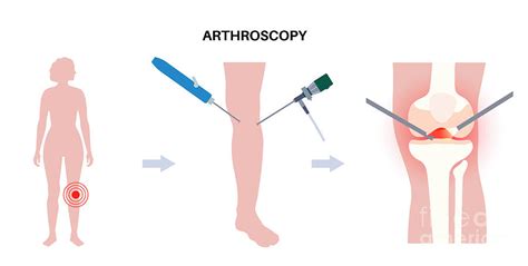 Knee Joint Arthroscopy 6 By Pikovit Science Photo Library