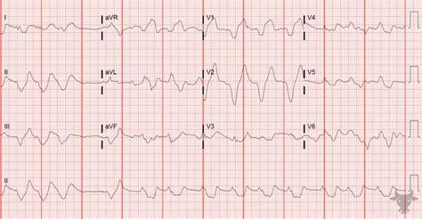 Hyperkalemia Ecg Stampede