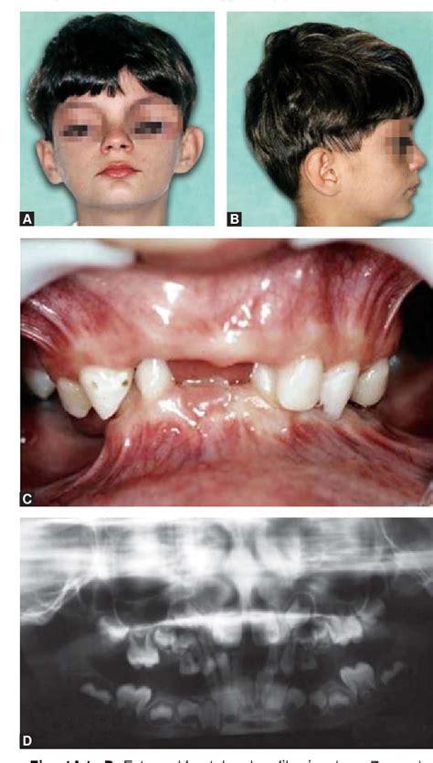 [pdf] Aarskog Scott Syndrome A Review And Case Report Semantic Scholar