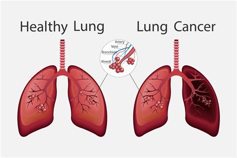 Unhealthy Lungs That You Might Die