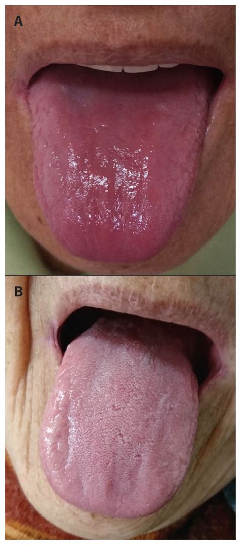 Pernicious Anemia Presenting As Glossitis Cmaj