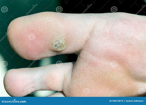 Plantar Wart On Big Toe Visible Black Dots Warts Stock Image Image Of Plantar Fingers 94615819