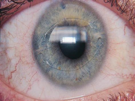 PHAKIC INTRAOCULAR LENS SURGERY