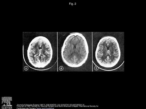 Cerebral Hyperperfusion Syndrome A Cause Of Neurologic Dysfunction