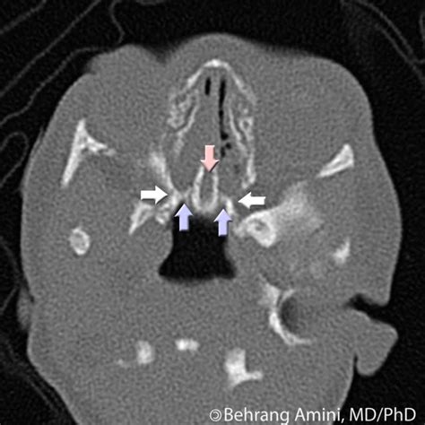 Roentgen Ray Reader Choanal Atresia
