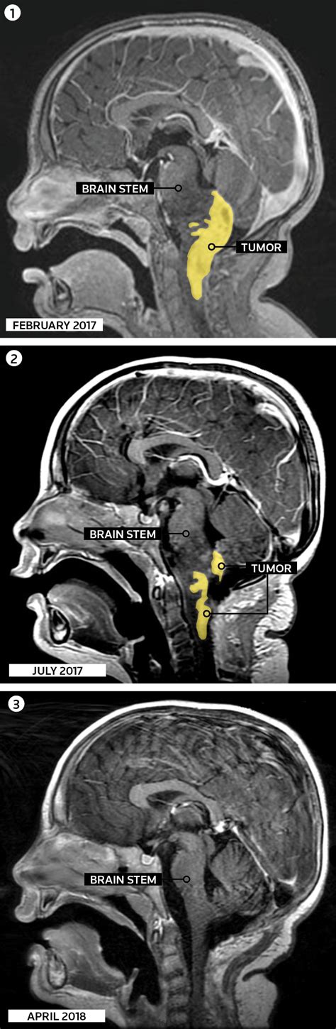 Brain Stem Tumor Symptoms