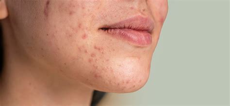 Small Skin Bumps Causes And Treatments Silkor Kuwait