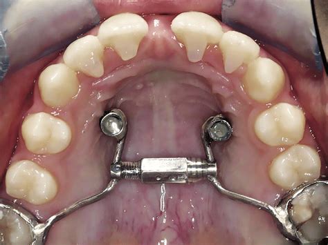 Pdf] Hyrax Versus Transverse Sagittal Maxillary Expander 44 Off