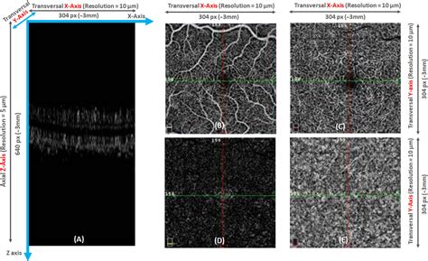 Figure 1 From Innovative Macula Capillaries Plexuses Visualization With