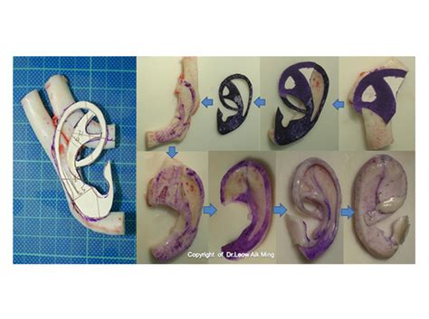 Ear Reconstruction Msprs