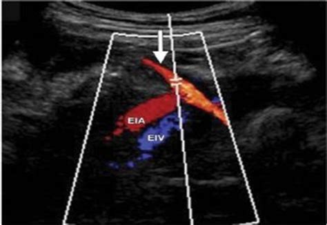 Figure 1 From First Trimester Uterine Artery Doppler Screening In The