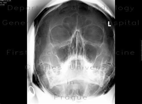 Radiology Case Polyp Of The Right Maxillary Sinus
