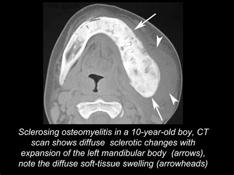 Introduction To Radiological Diagnosis Of Osteomyelitis For Undergraduates Pptx